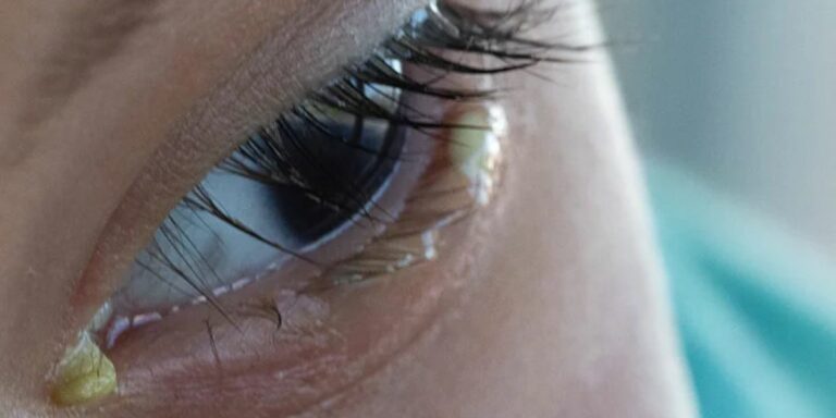 Crusty Eyes in the Morning: Benign or Serious?